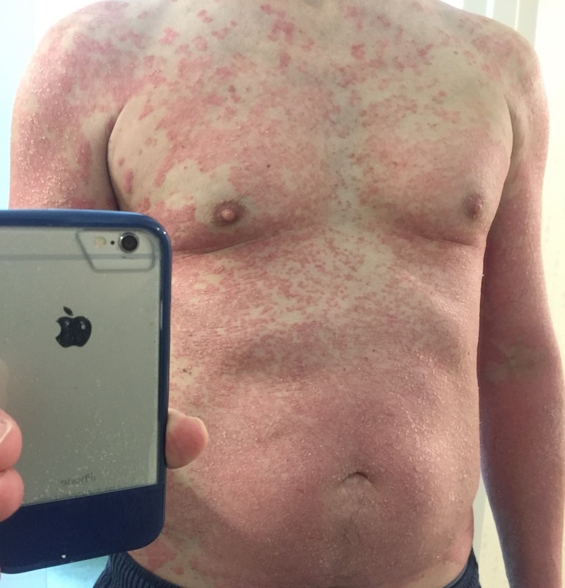 Psoriasis Journey - Psoriasis Cure Now